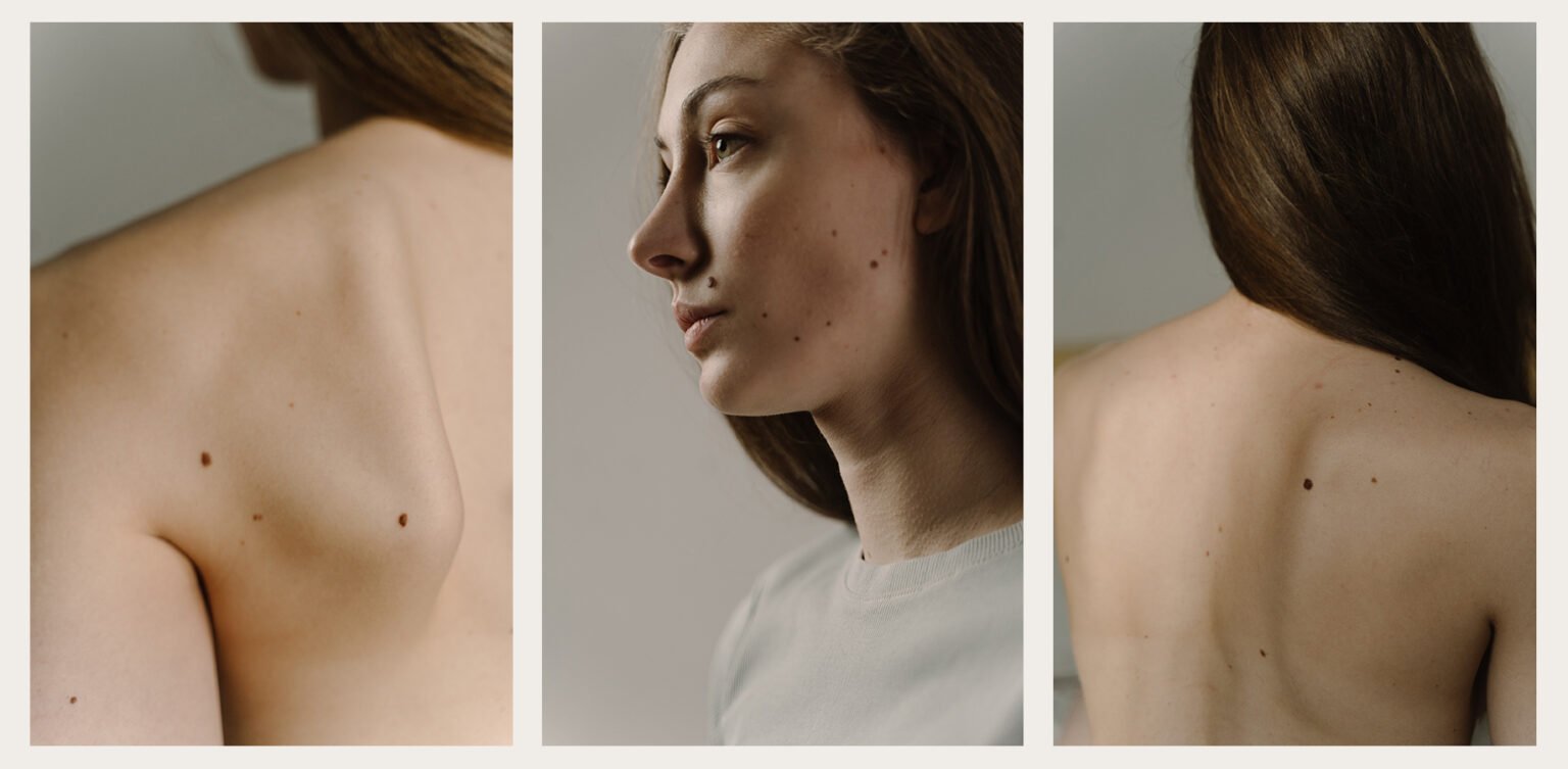 Mole Removal | The Dermatology Clinic London
