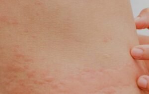 Chronic Urticaria (Hives) Treatment London - Hives Specialist Doctor UK