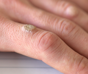 Warts & Verrucae Treatment London - The Dermatology Clinic, UK