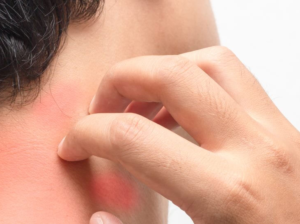 Skin Allergies - Why they Happen and How to Take Care of Them